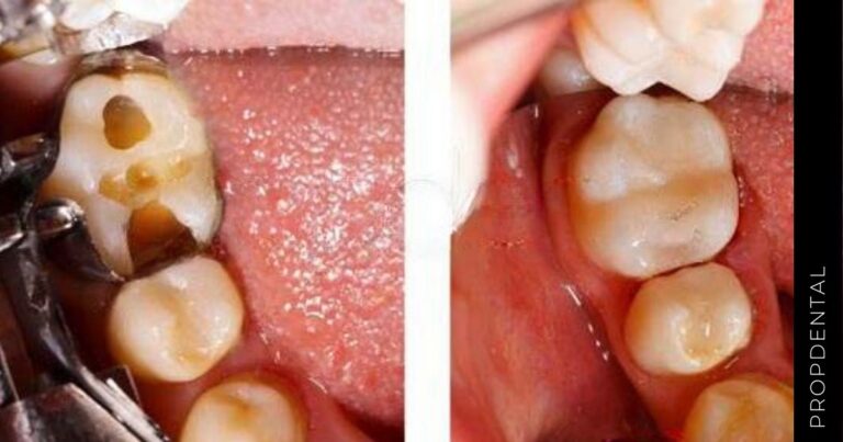 Restauración Dental: Guía Completa para Tu Sonrisa | Nautilus